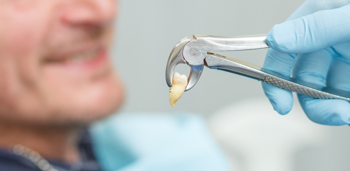 Natural Ways to Support Healing After a Tooth Extraction