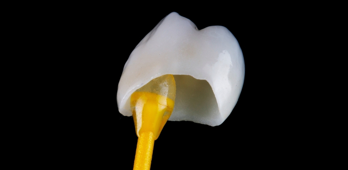 Broken Crown: Should You Repair or Replace It?